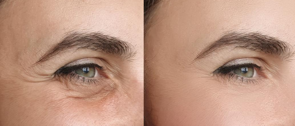 Body, Neck, Face and Under Eye Skin Tightening Procedures